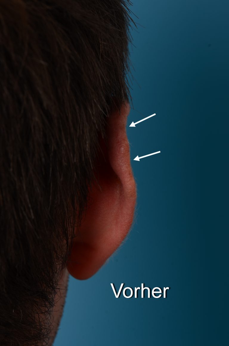 Reconstruction of the helical rim - Dr. Gassner