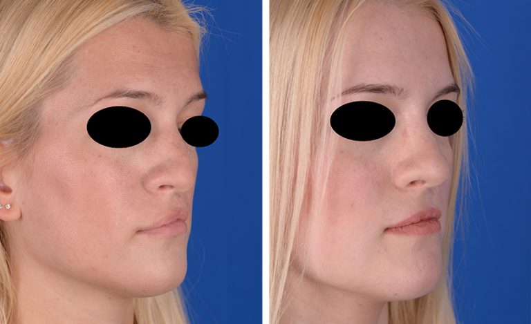 Septorhinoplasty Cleft Nose 2 Dr Gassner